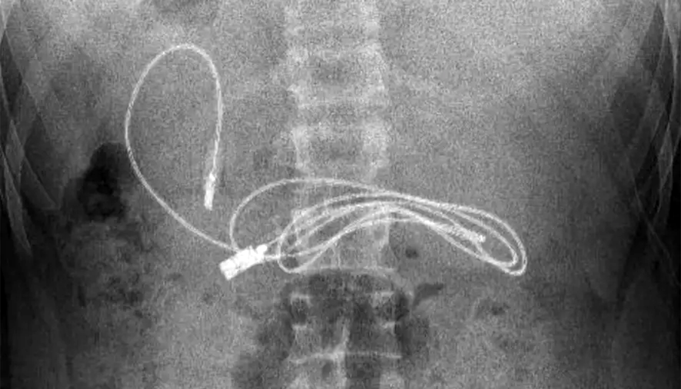 Medicii au crezut că nu văd bine! Ce gadget au putut găsi în stomacul ...