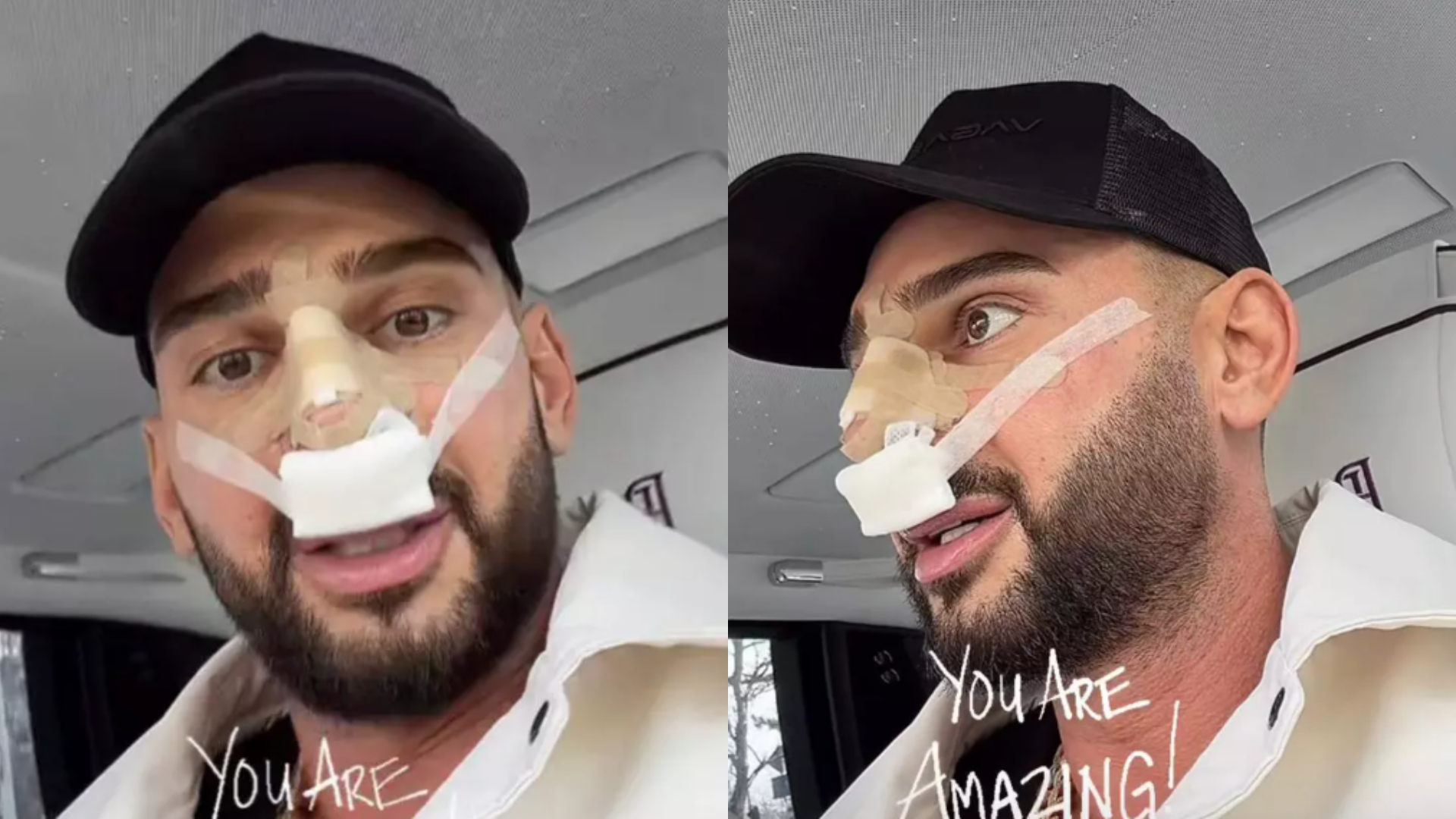 Cum arată nasul lui Dorian Popa, la 12 zile de la intervenție. Artistul ...